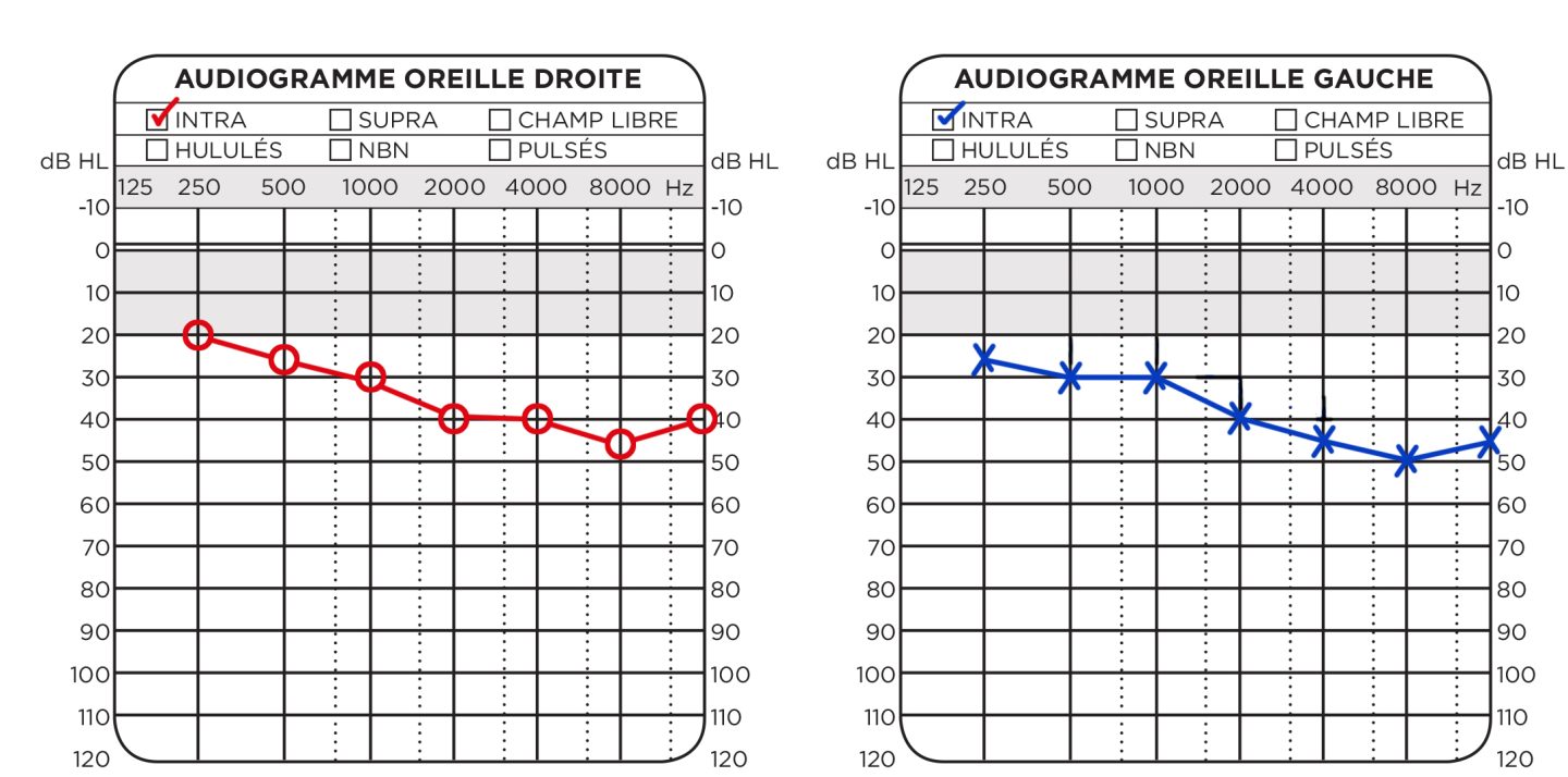 Audiogramme - Polyclinique de l'Oreille